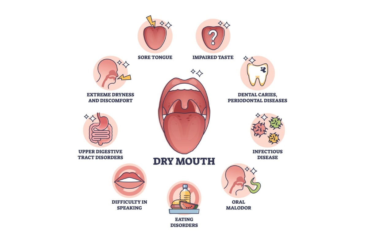 Can Dry Mouth Cause Cavities?